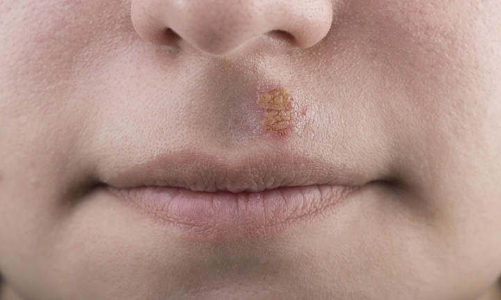 Canker Sores In Children – Causes, Treatment And Remedies