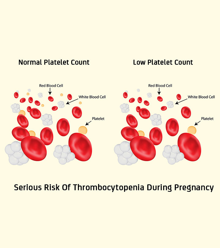Thrombocytopenia In Pregnancy: Comprehensive Guide