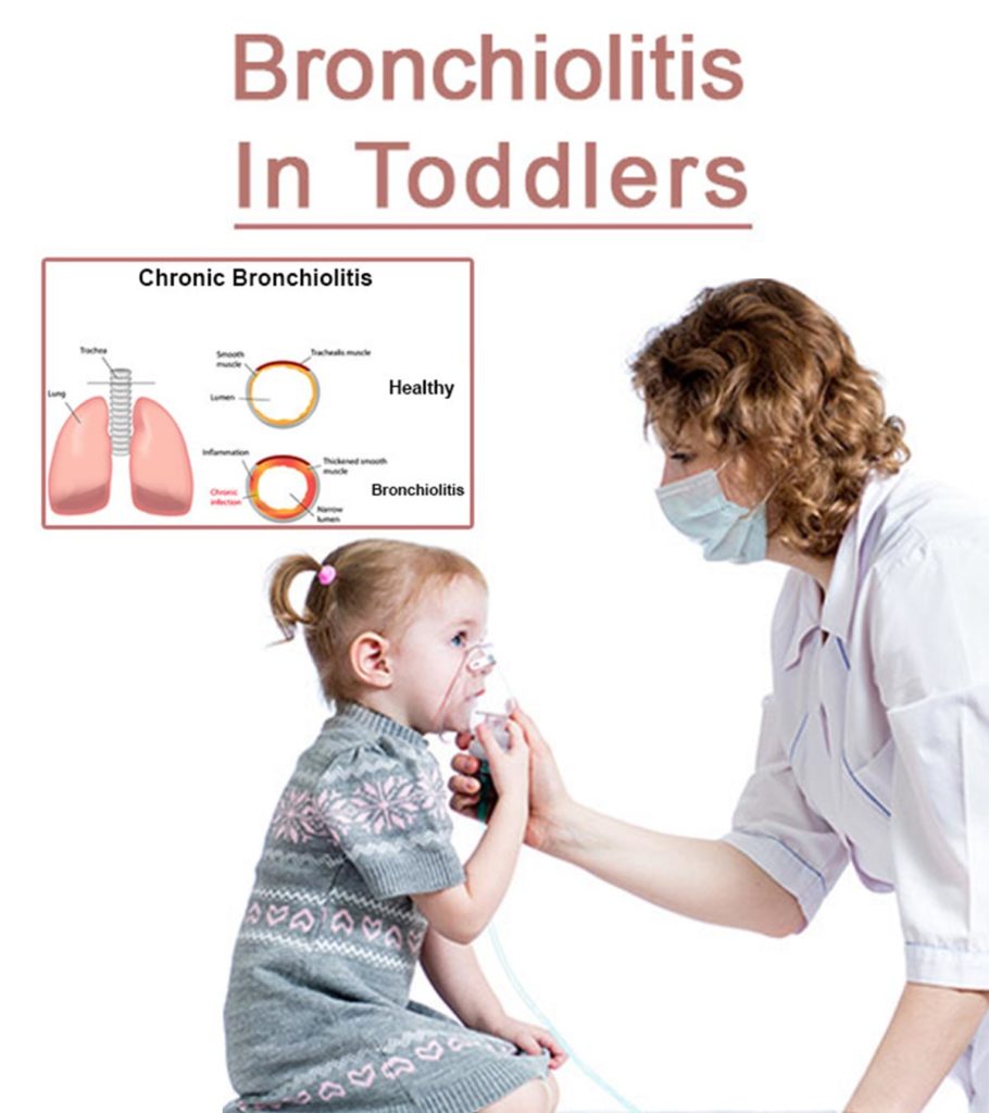 Bronchiolitis In Toddlers – Causes, Symptoms And Treatments