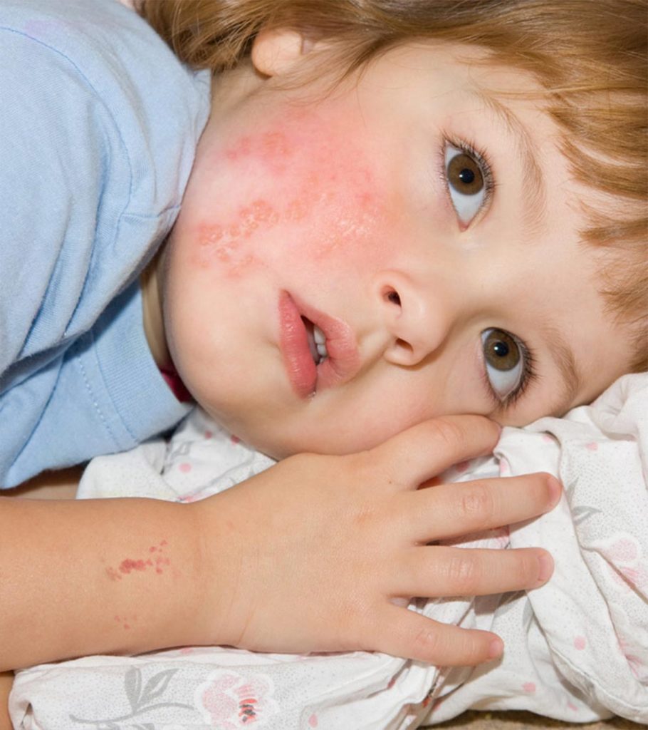 Shingles In Children: Essential Symptoms Treatment & Prevention