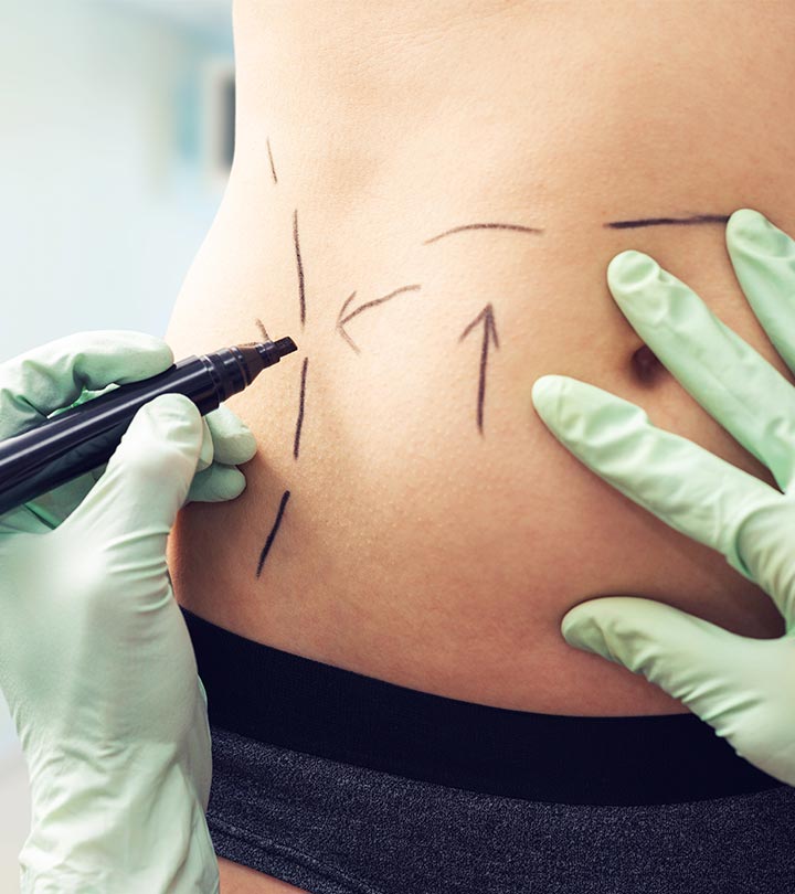 Laser Liposuction Vs Lipolysis: 2 Top Fat Removal Options