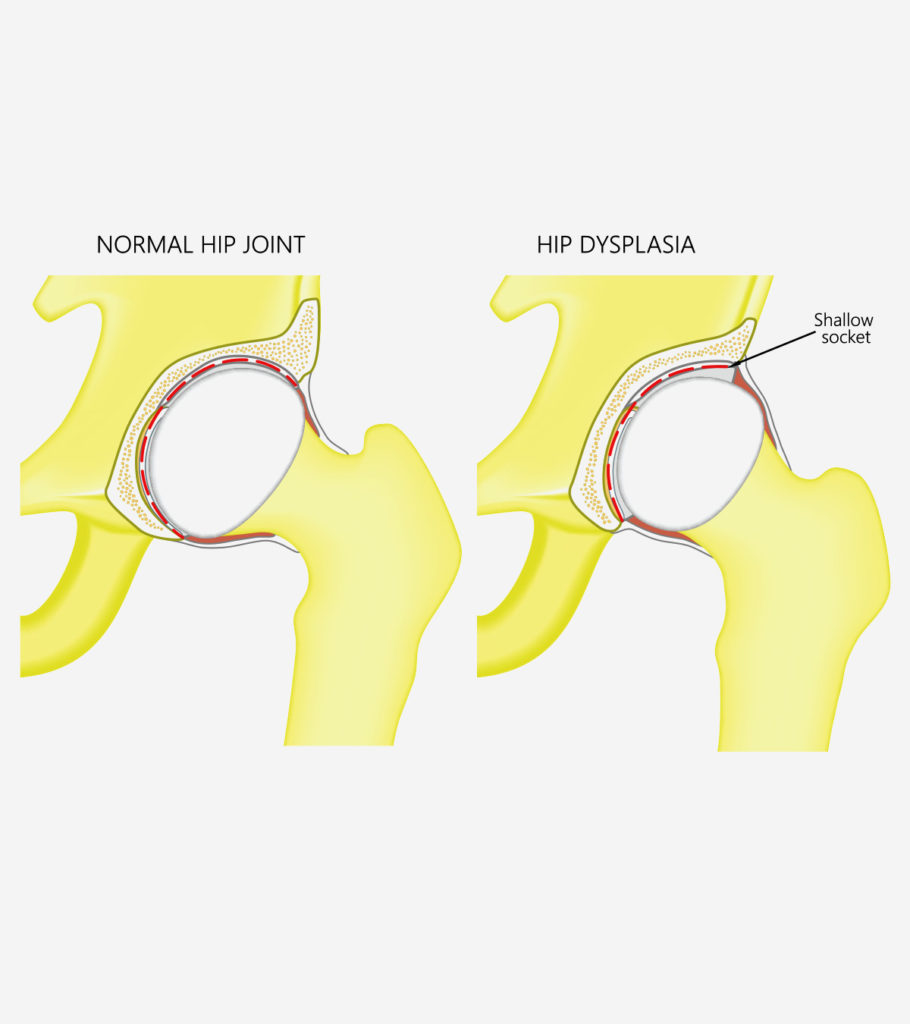 Hip Dysplasia In Babies: Symptoms, Diagnosis & Treatment Guide