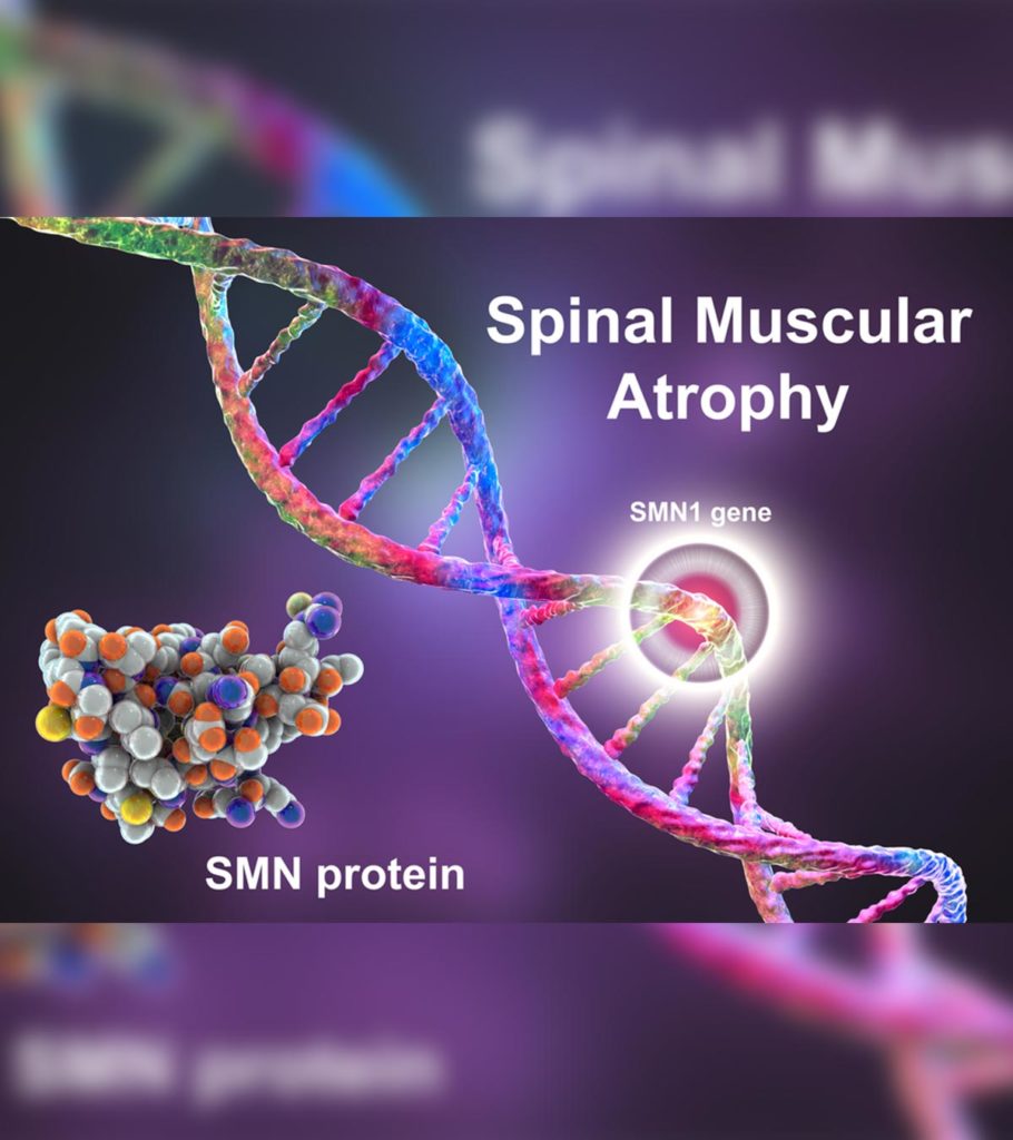 Spinal Muscular Atrophy In Babies: Types, Symptoms & Treatment