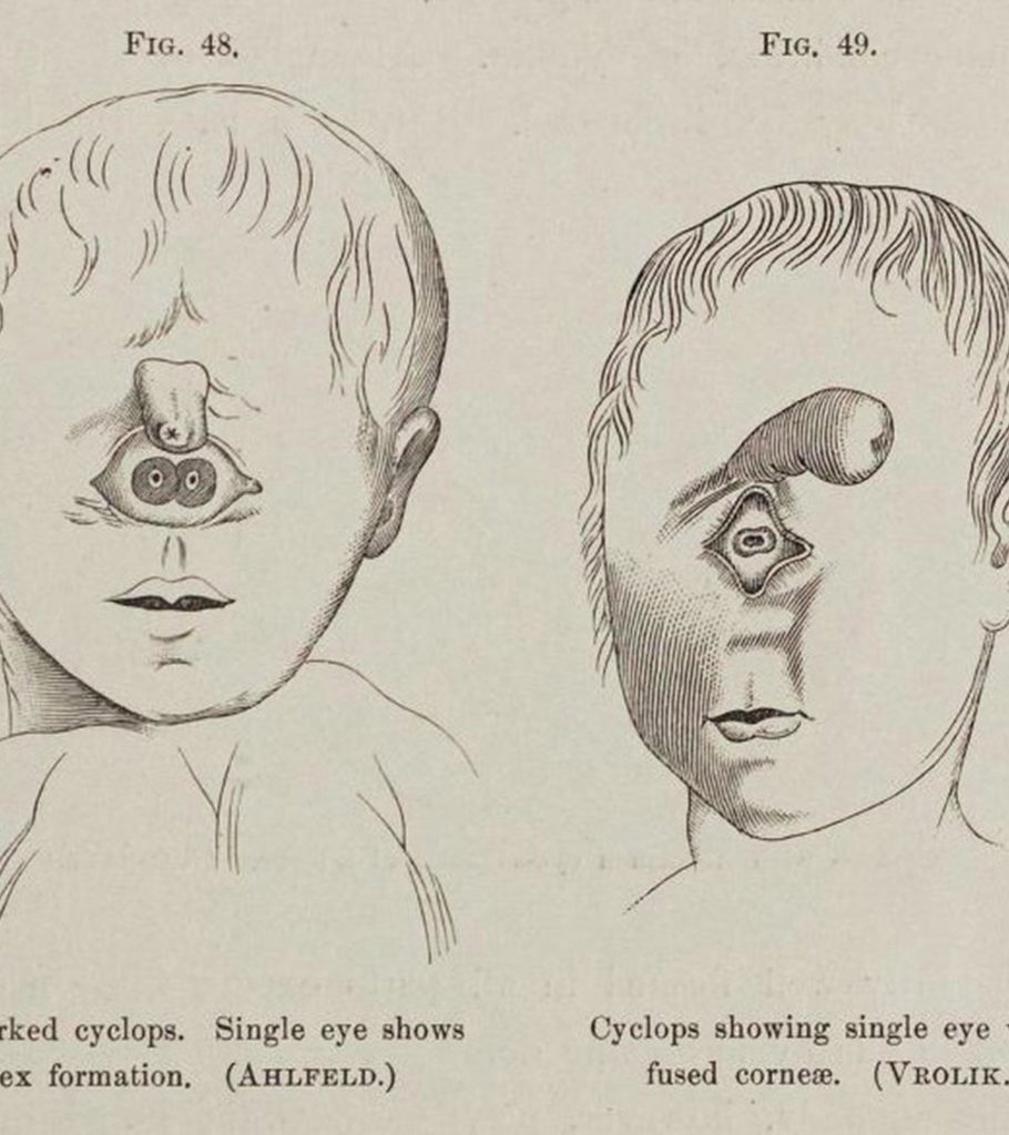 Cyclopia In Babies: Guide To Causes, Diagnosis & Prognosis