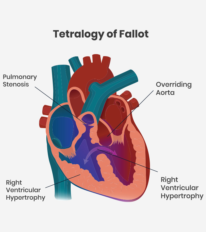 Tetralogy Of Fallot In Babies: What It Is, Symptoms & Treatment