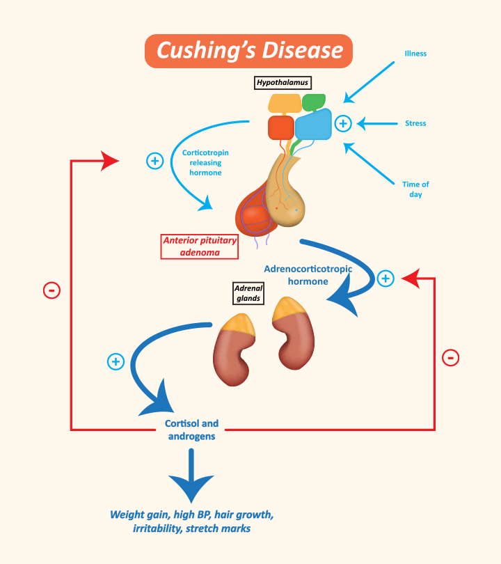 Cushing Syndrome In Children – 5 Facts: Causes, Symptoms & Care